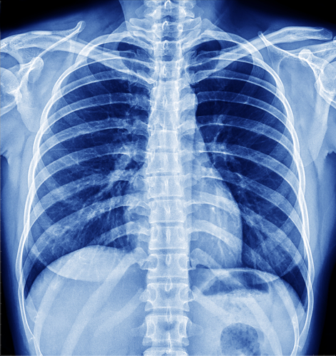 A History of X-Ray - The Evolution of Medical Imaging Technology